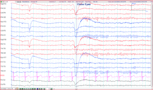 What is an EEG? | Association of Neurophysiology Scientists of ...